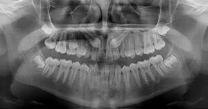 Palatal Expanders for Kids: A Parent’s Guide - Bird Smiles Orthodontics